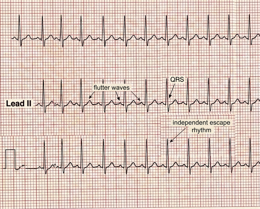 Third-Degree Complete Heart Block | ACLS Certification Association
