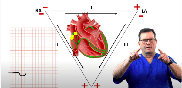 Einthoven’s Triangle Explained: ECG Leads I, II & III