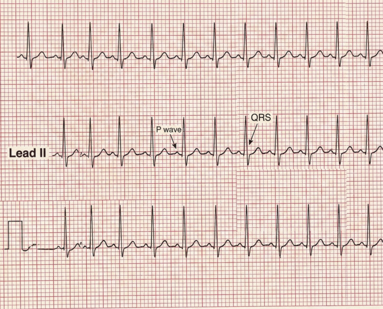 Third-Degree Complete Heart Block | ACLS Certification Association