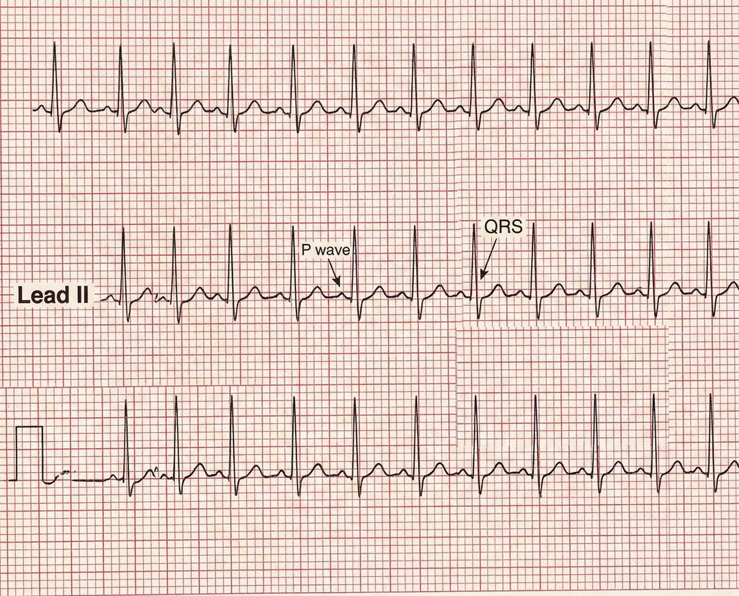 Third-Degree Complete Heart Block | ACLS Certification Association