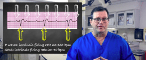 Third-Degree Complete Heart Block | 12-Lead ECG Resources | ACLS ...
