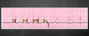 Second-Degree Heart Block | 12-Lead ECG Resources | ACLS Certification ...