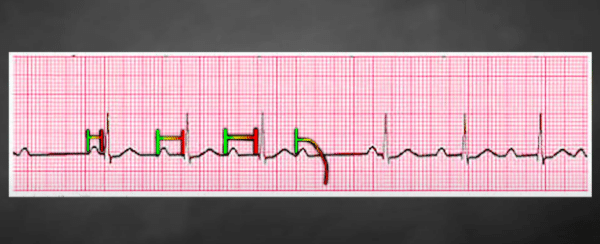 Second-Degree Heart Block | 12-Lead ECG Resources | ACLS Certification ...