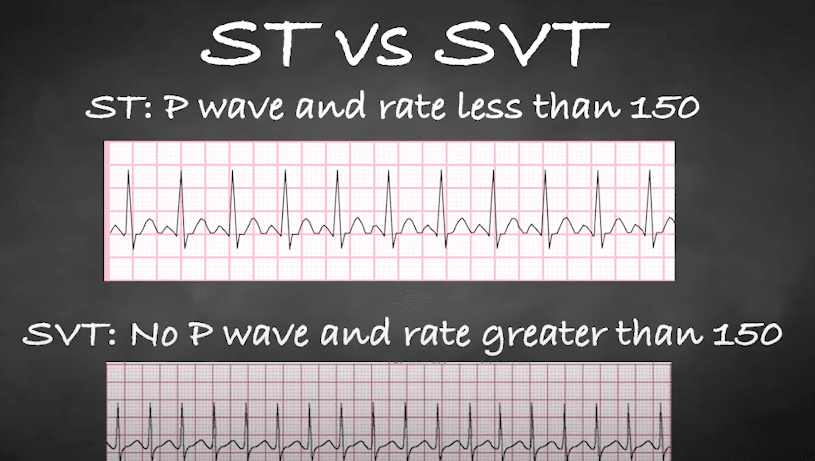 Supraventricular Tachycardia Ecg Changes Supraventricular Tachycardia Ecg Changes