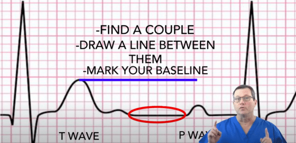 ST-Segment Elevation: ECG Criteria, Causes, & STEMI Mimics