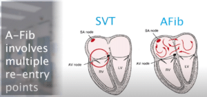 Adenosine Injection | ACLS Drugs | SVT Adenosine Dosing | ACLS ...
